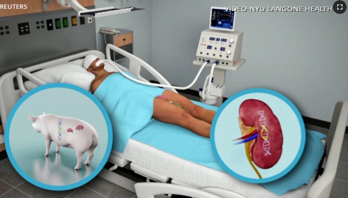 Operacion eksperimental, transplanti i veshkës së derrit tek njeriu - Alsat