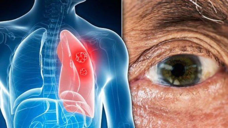 5 shenjat e pabesueshme, por që tregojnë se mushkëritë tuaja janë në ...