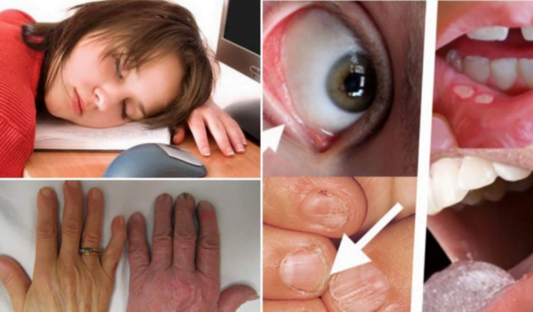 Shenjat që tregojnë se ju mungon hekuri - Alsat